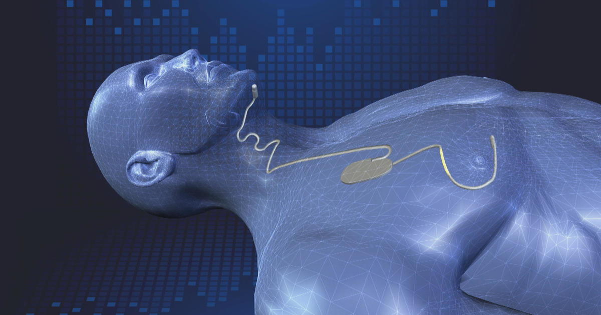 Global Sleep Apnea Implants Industry is Expected to Grow at an Exciting ...