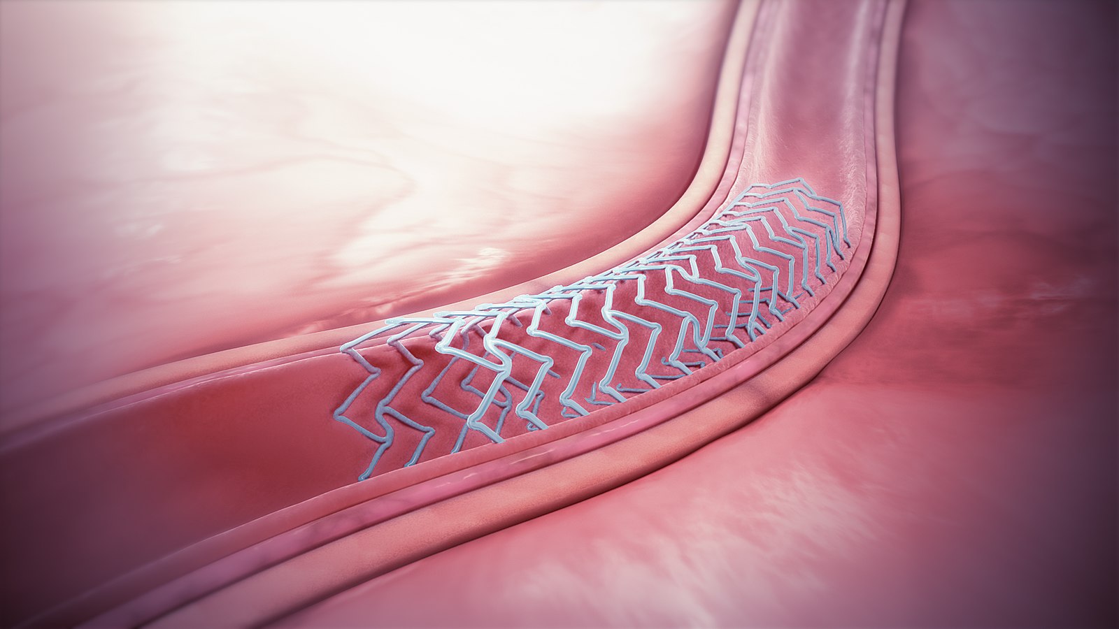 Global Peripheral Vascular Stent Market Poised for Growth, Projected to ...