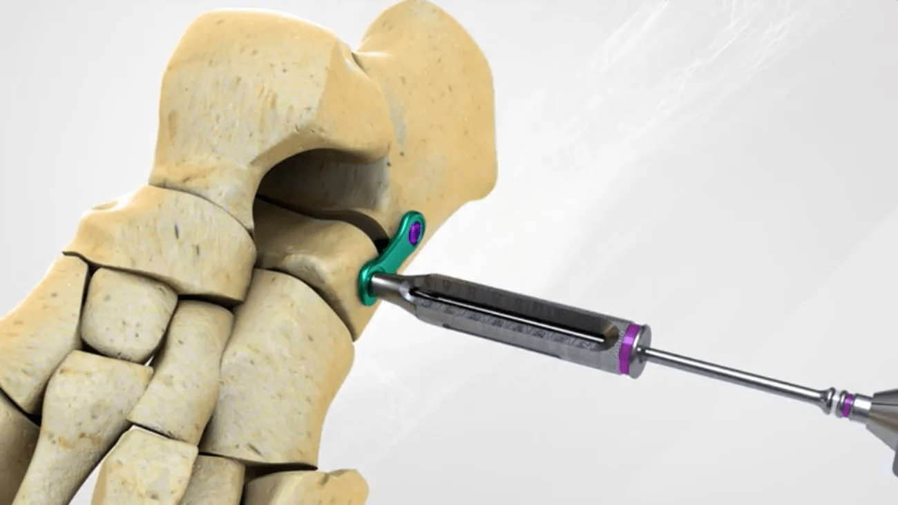 Global Osteotomy Plates Market Set for Exponential Growth, Reaching USD ...