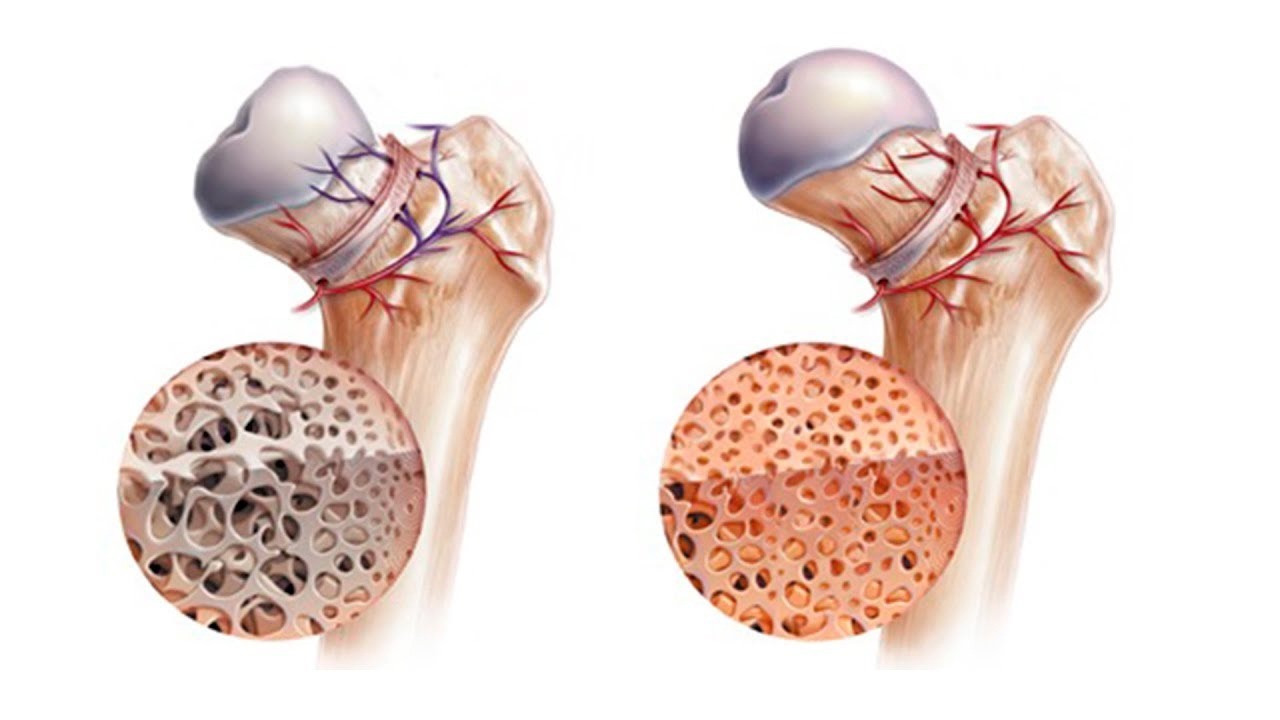 Osteonecrosis Treatment Market to See Incredible Growth, With a 4.9% ...