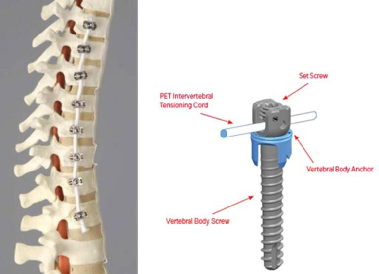 Dynamic Spinal Tethering Systems Market Set for Explosive Growth: $154. ...
